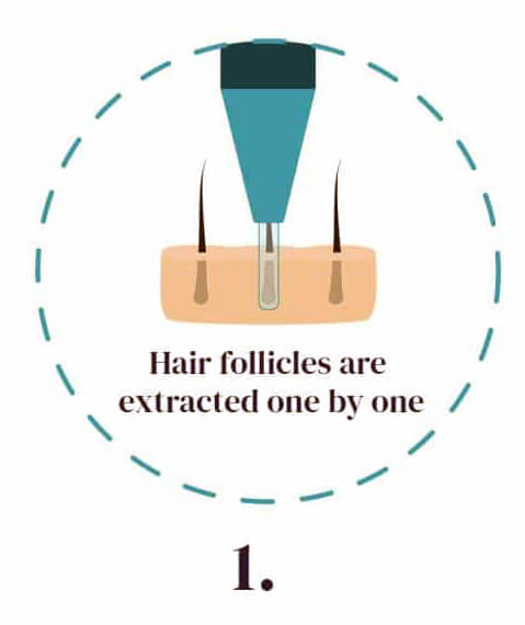 DHI Hair Transplant | MedPrime Hair Clinic
