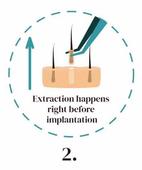 DHI Hair Transplant | MedPrime Hair Clinic