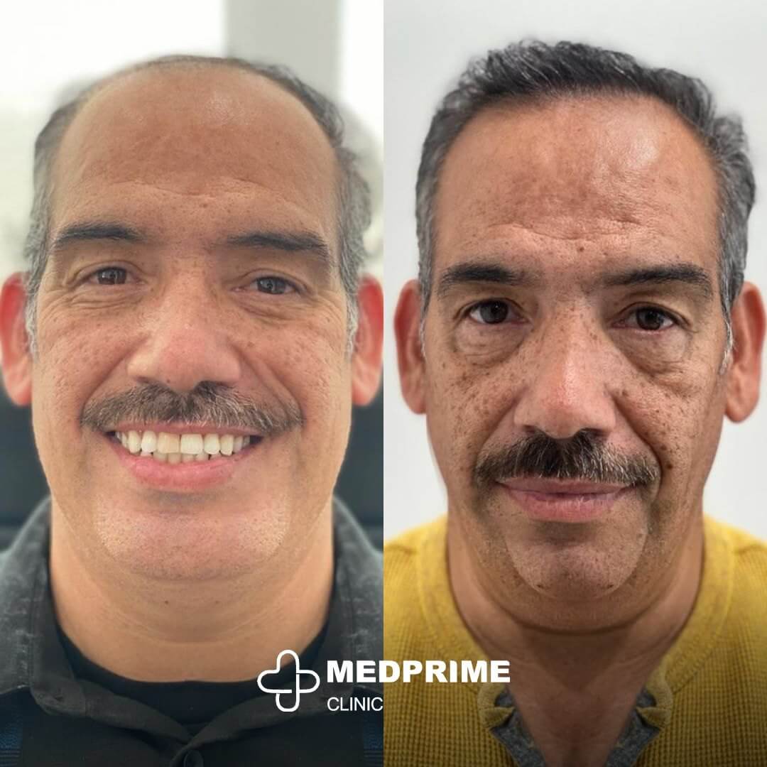 Hair Transplant Turkey Before and After - MedPrime Hair Clinic