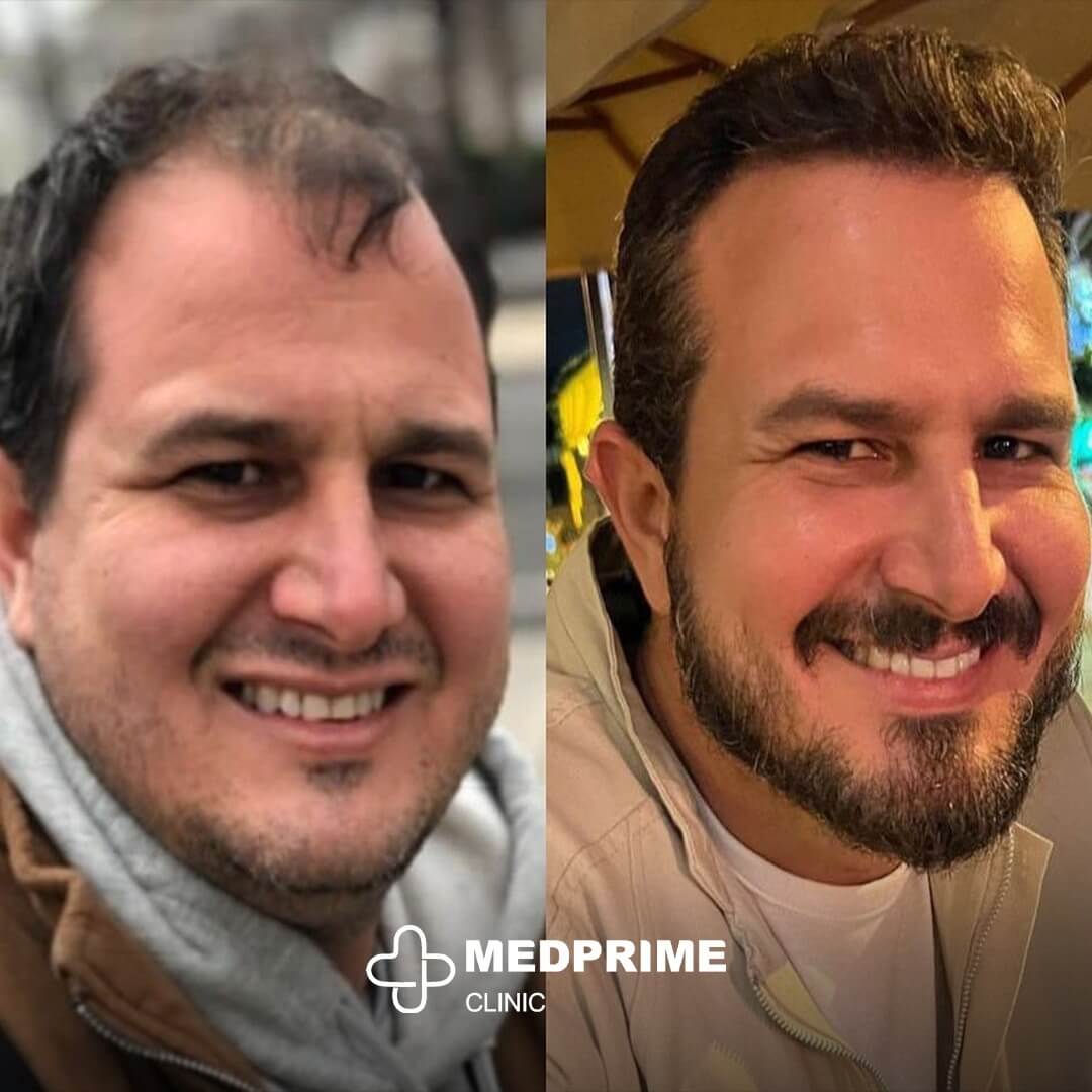 Hair Transplant Turkey Before and After - MedPrime Hair Clinic